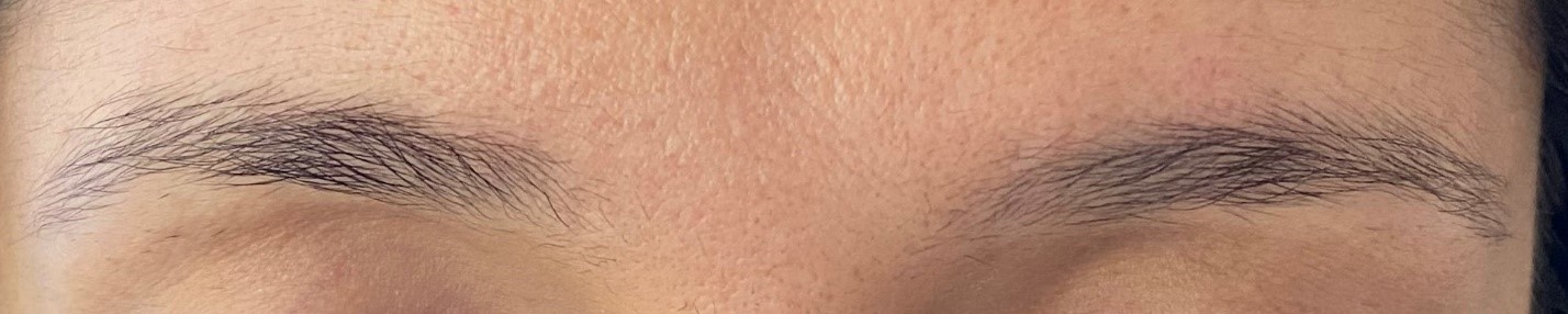 Regen hair loss – AG Pain Management TX
